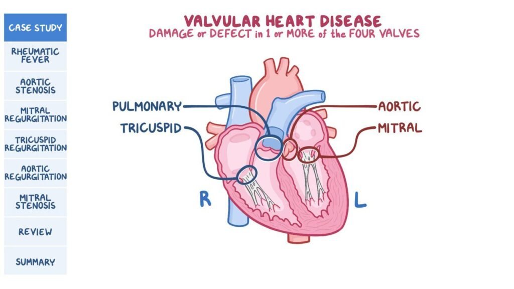 Valvular Heart Disease | CHAPTER 10 | Pediatric Nursing - Nursing ...