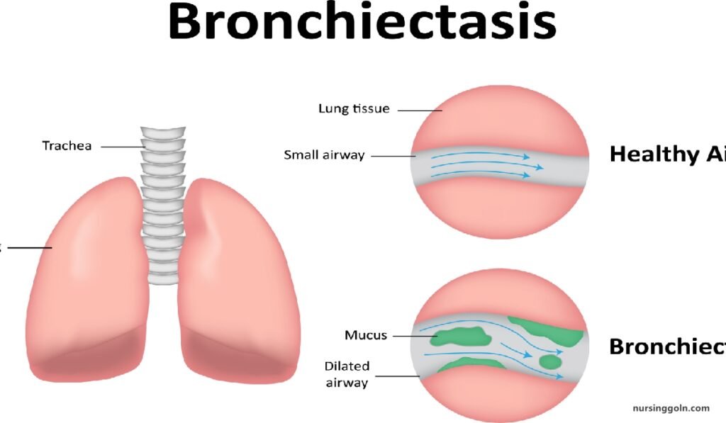 Definition of Bronchiectasis | CHAPTER-8 | Medical and Surgical Nursing ...