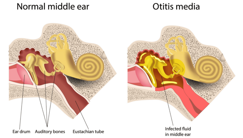 Definition of Otitis media | CHAPTER 6 | Pediatric Nursing - Nursing ...