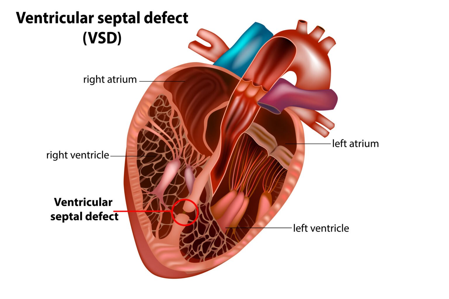 Ventricular septal defect (VSD) | CHAPTER 10 | Pediatric Nursing ...