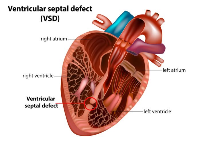 Ventricular septal defect (VSD) | CHAPTER 10 | Pediatric Nursing ...