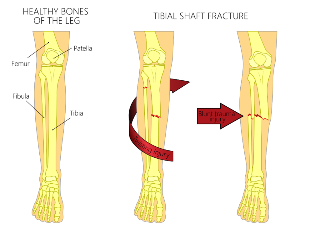 Definition of Fracture | CHAPTER 21 | Fundamentals of Nursing - Nursing ...