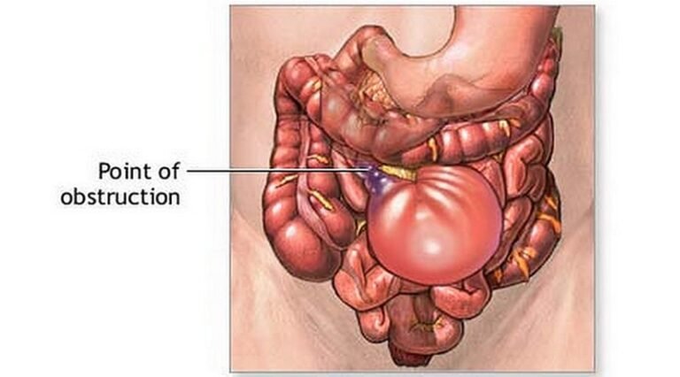 Bowel Intestinal Obstruction | CHAPTER-6 | Medical and Surgical Nursing ...