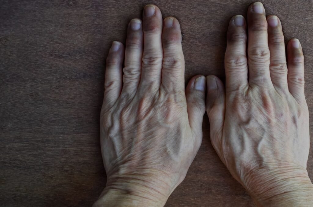 Definition of Cyanosis | CHAPTER-19: General Examination | Fundamentals ...