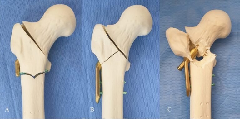 Fracture of Neck of Femur (NOF) | CHAPTER 5 | Orthopedic Nursing ...