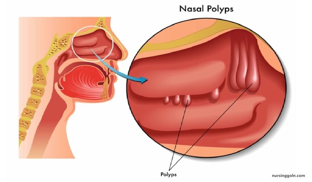 Nasal polyps | CHAPTER-10 | Medical and Surgical Nursing - Nursing ...