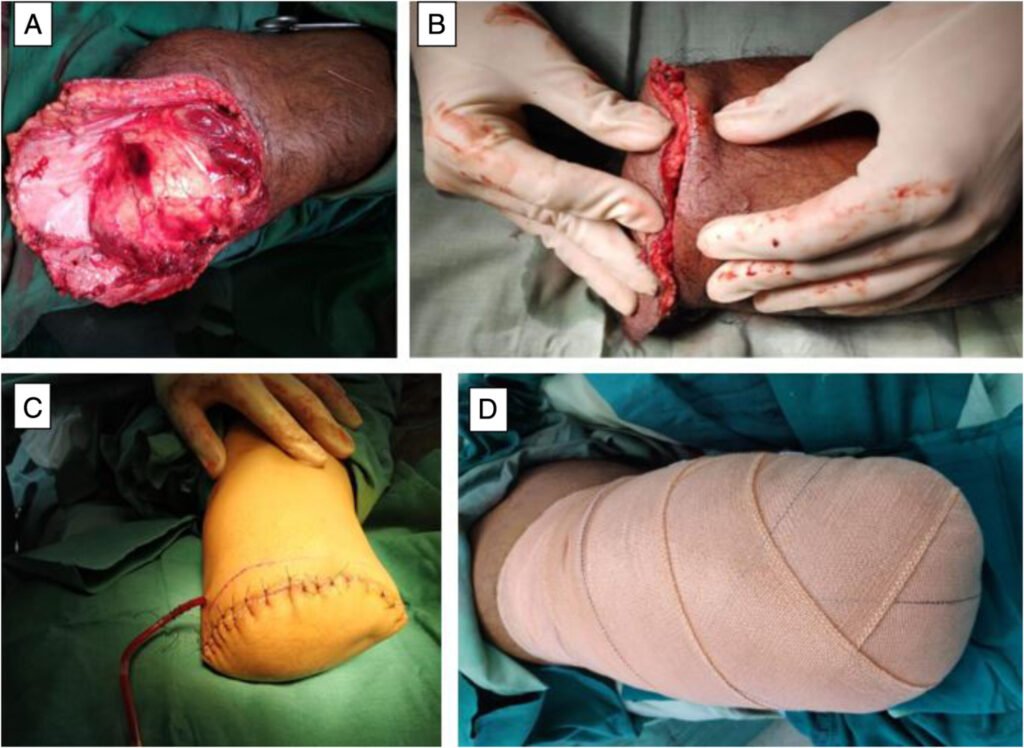 Definition of Amputation | CHAPTER 9 | Orthopedic Nursing - Nursing ...