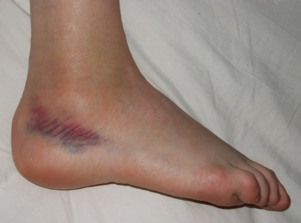 Medical Definition of Sprain | CHAPTER 6 | Orthopedic Nursing - Nursing ...