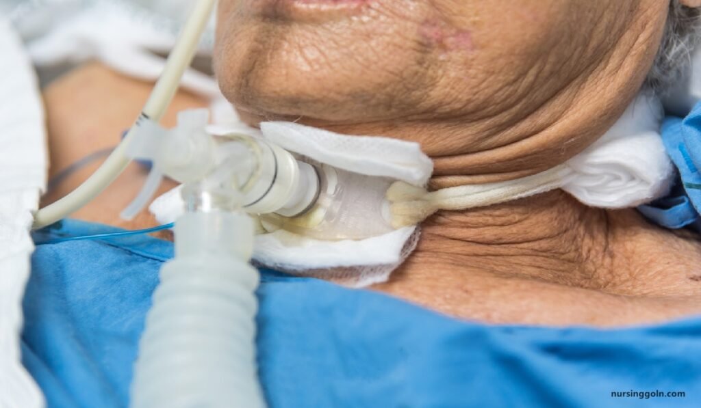 Tonsillitis and Tracheostomy | CHAPTER-10 | Medical and Surgical ...