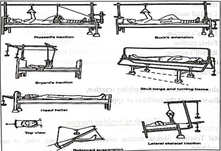 Concept about Traction | CHAPTER 13 | Basic Science - Nursing ...
